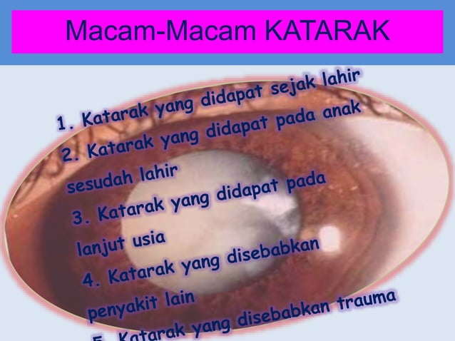 SAP KATARAK | PPT