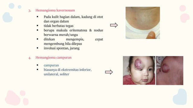 KEL 2 asuhan NEONATUS dan bayi dengan masalah hemagioma.pptx