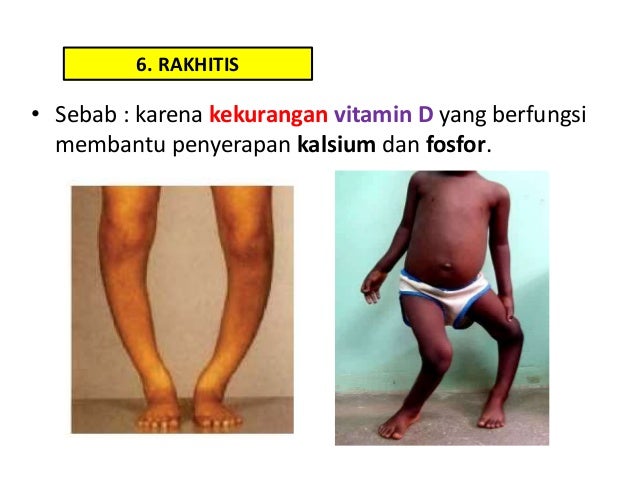 Kelainan Sistem Gerak