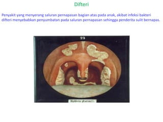 Kelainan dan penyakit pada sistem pernapasan | PPTX