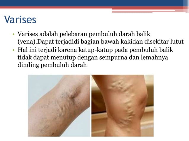 Kelainan dan Gangguan Sistem Sirkulasi Darah | PPT