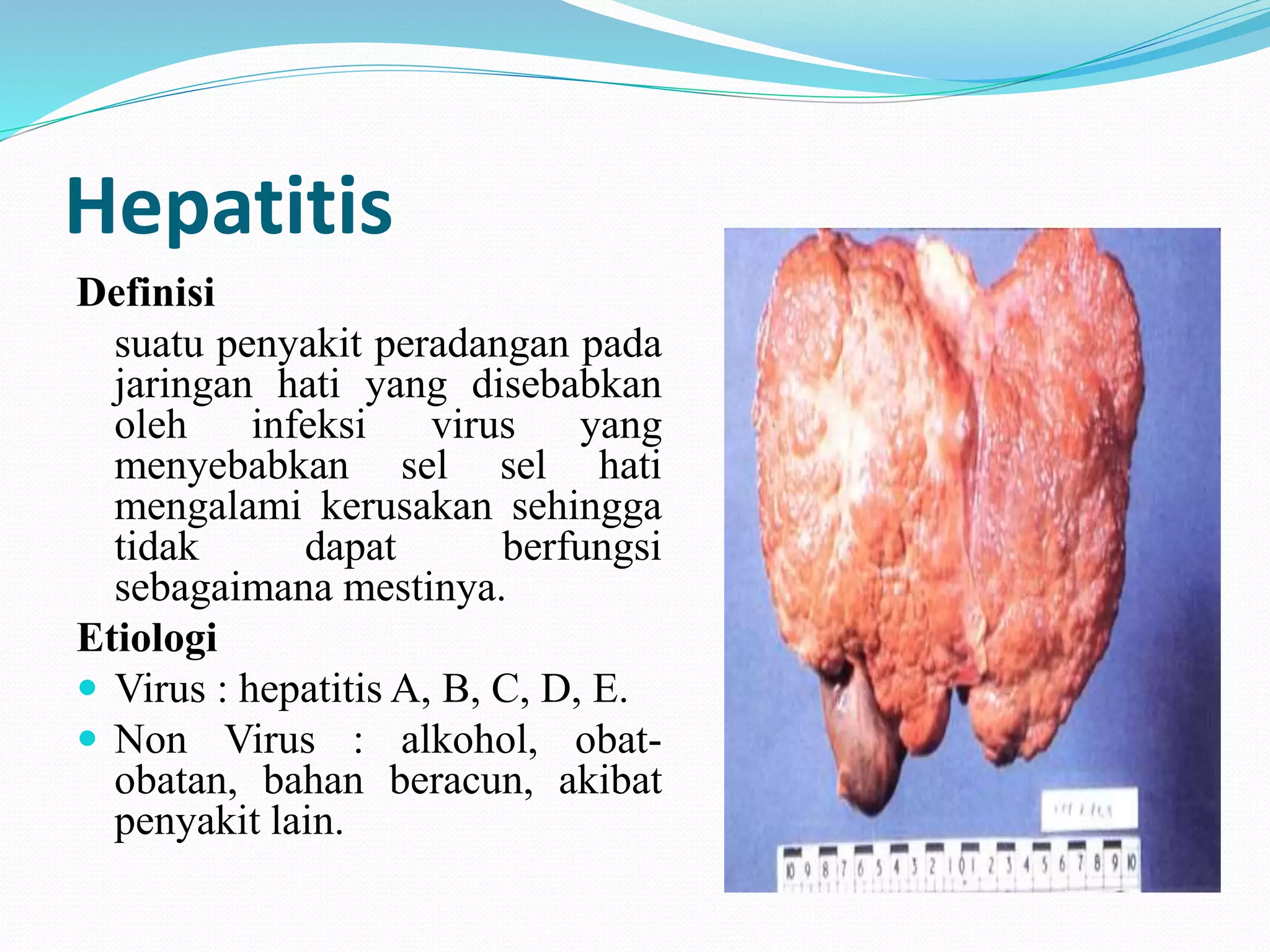 Kelainan pada hati | PPTX
