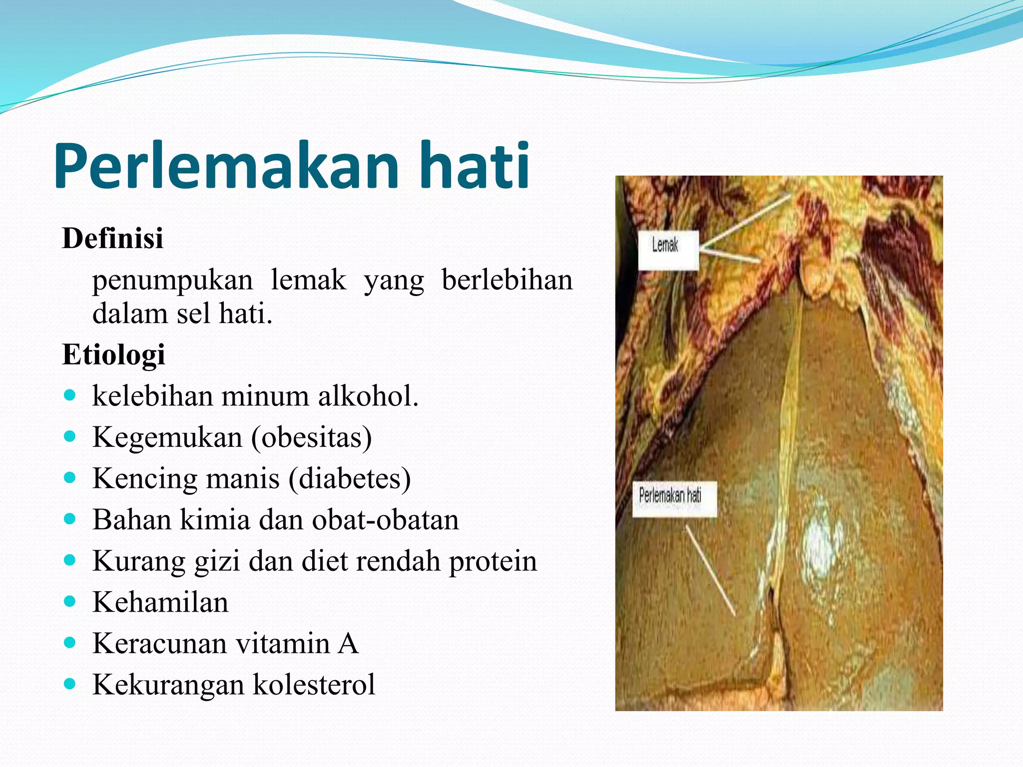 Kelainan pada hati | PPTX