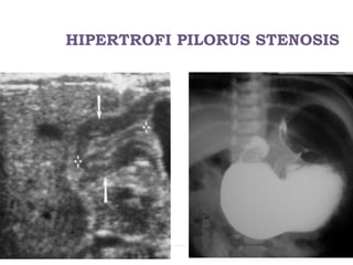 Kelainan pada usus halus | PPT