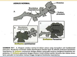 Asuhan Keperawatan Emfisema | PPTX