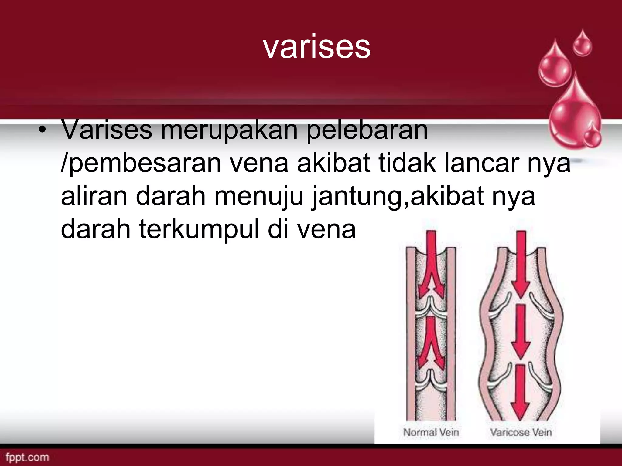 Kelainan sistem peredaran darah | PPTX