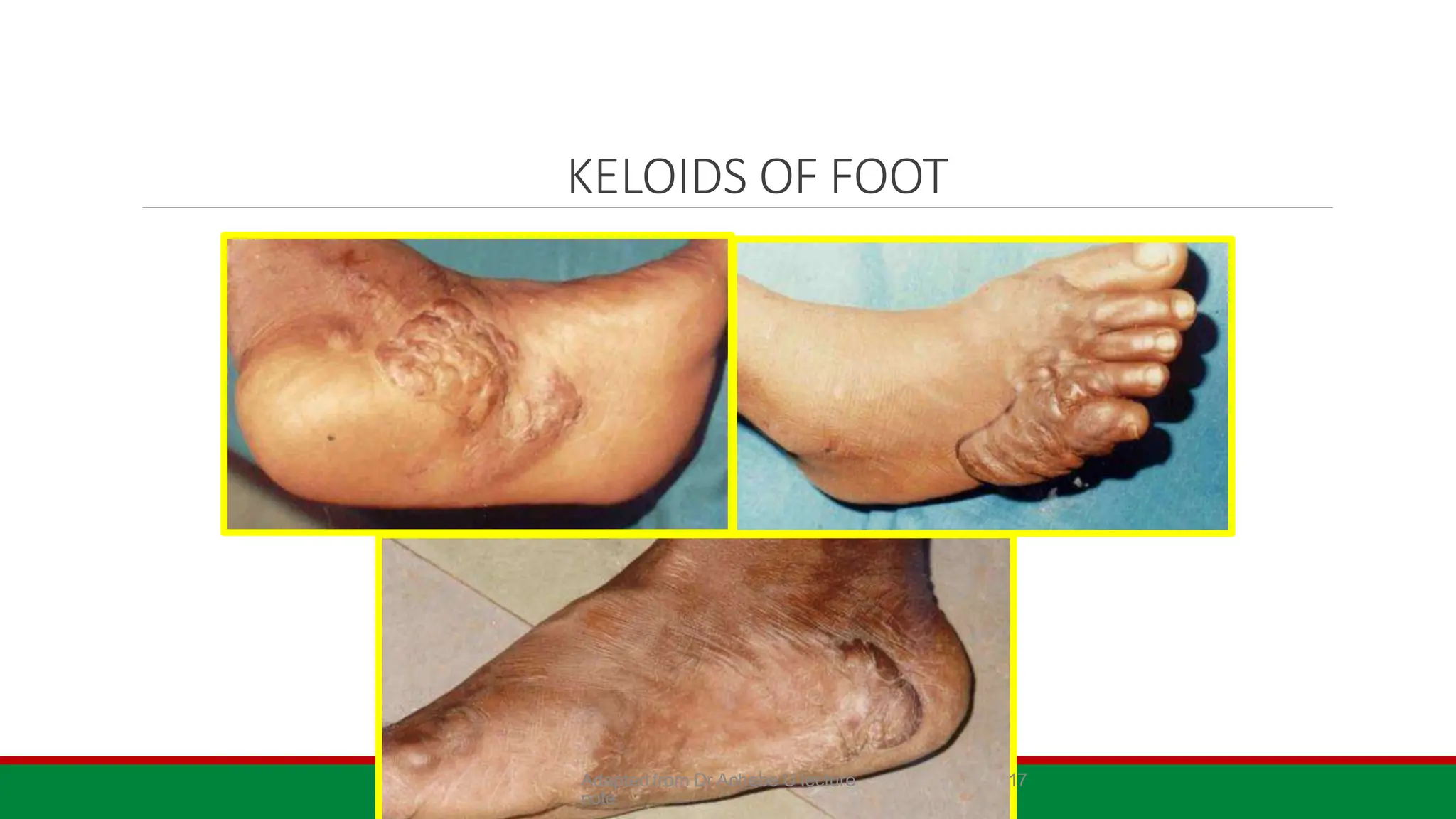 keloids and Hypertrophic Scars. Presentation and management options | PPTX