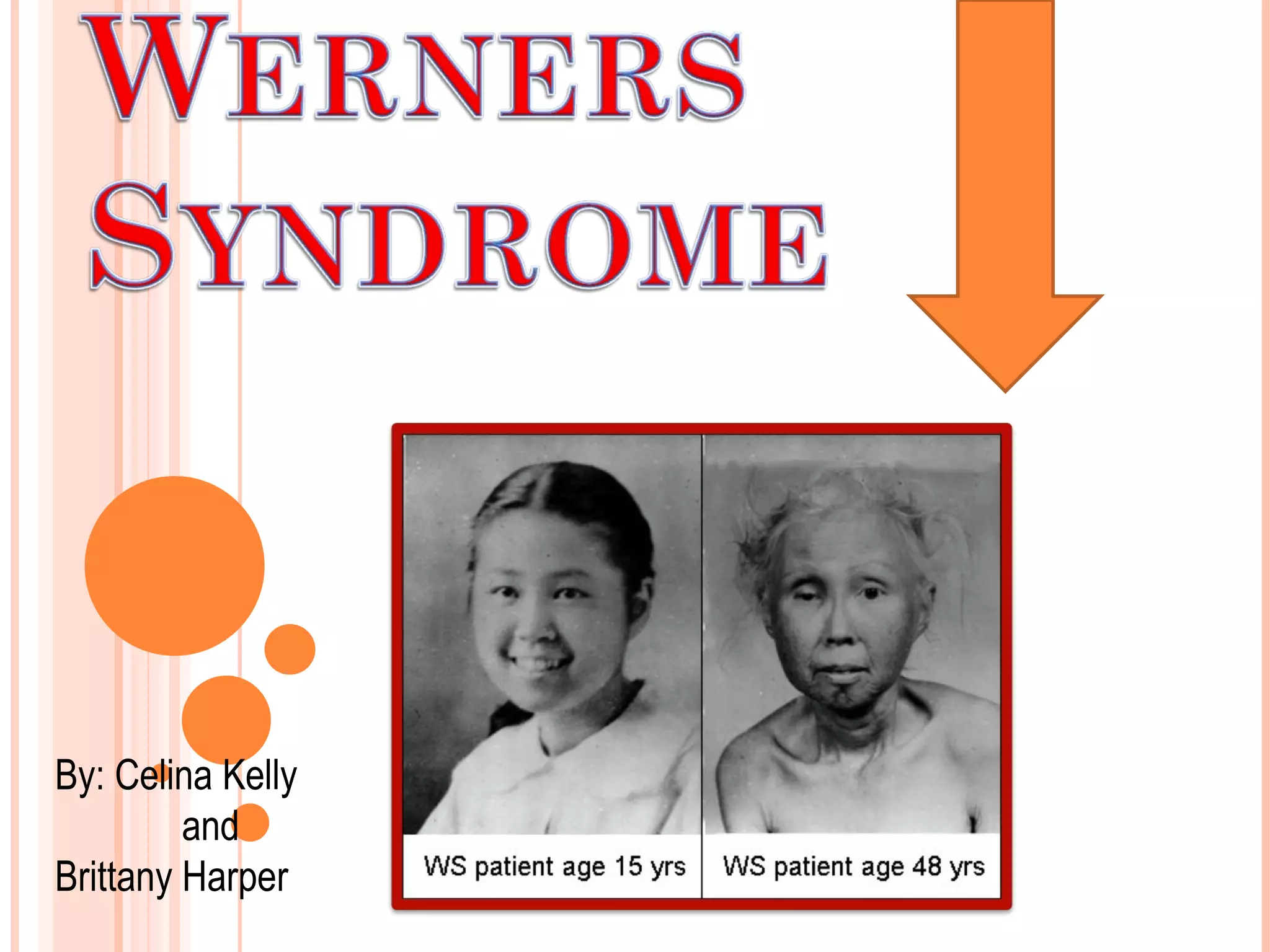 Werners Syndrome | PPT