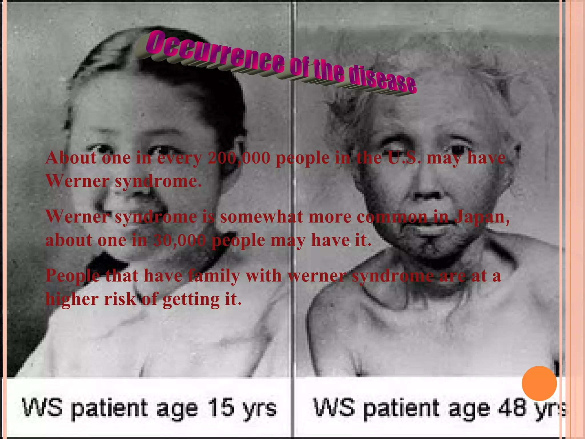 Werners Syndrome | PPT