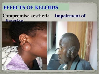 Keloid Disease (Case Presentation) | PPT