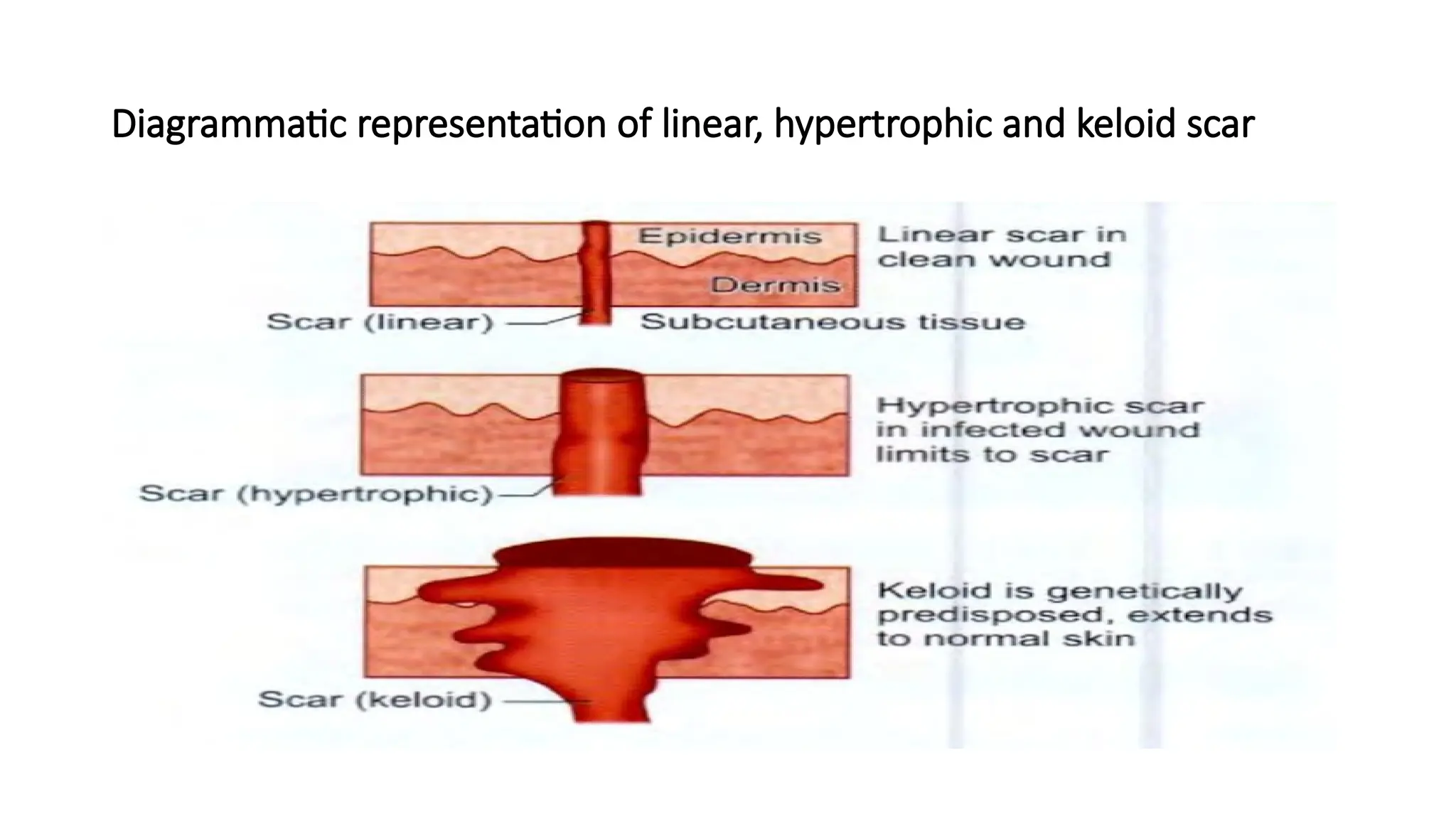 keloid, hyper scar, lipoma, derm cyst, seb cyst.pptx