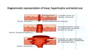 keloid, hyper scar, lipoma, derm cyst, seb cyst.pptx