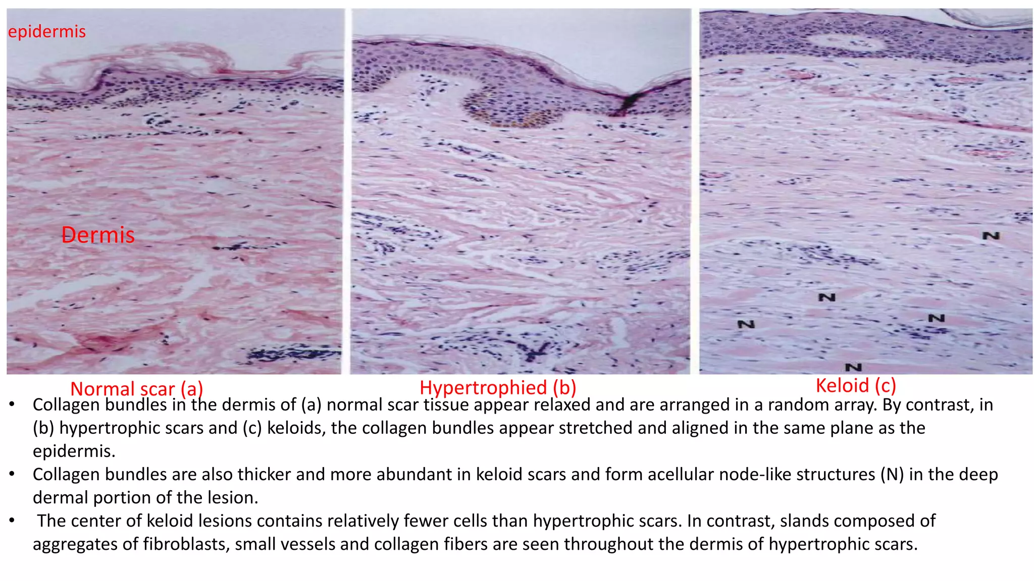 ear/aural keloid | PPTX
