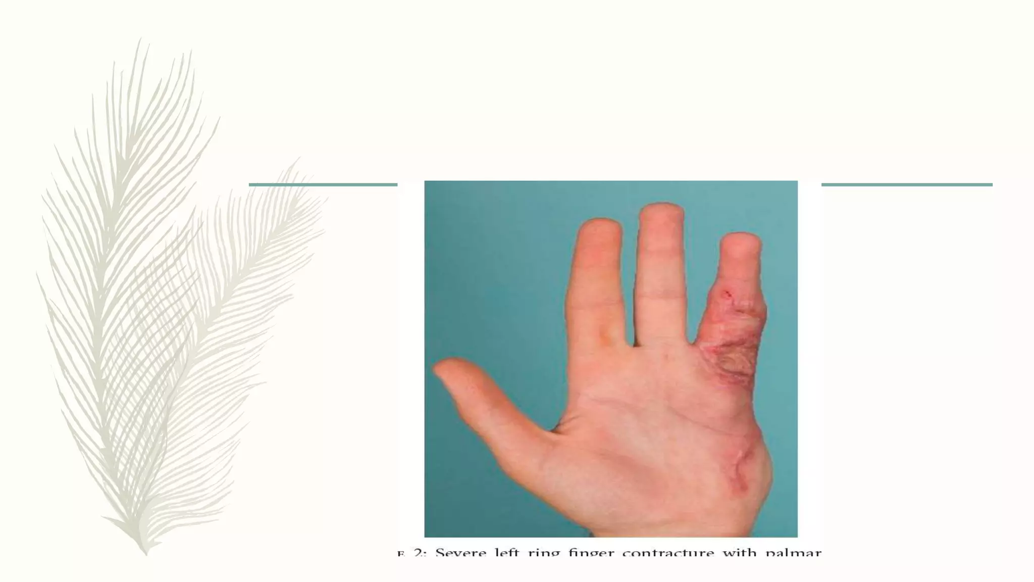 Keloids | PPTX