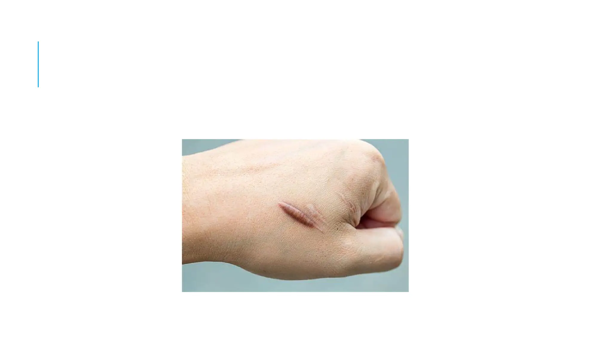 HYPERGRANULATED SCARkeloids AFTER WOUND MANAGEMENT | PPT