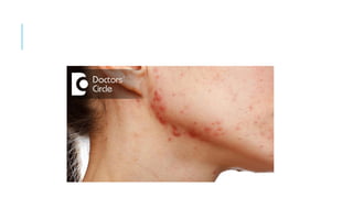 HYPERGRANULATED SCARkeloids AFTER WOUND MANAGEMENT | PPTX