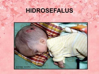 hidrosefalus nra (fitria, francisca, hernik) | PPTX