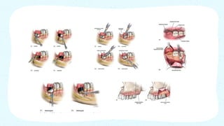 odontektomi kesehatan gigi dan miuulut di | PPTX