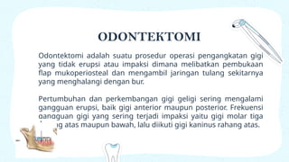 odontektomi kesehatan gigi dan miuulut di | PPTX