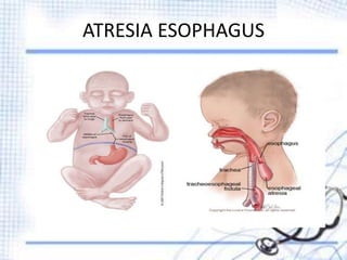 Athresia Esophagus, pengertian Athresia Esophagus, Athresia Esophagus ...