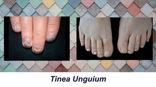Kelompok 3_Kelas B_Dermatofitosis-Tinea Unguium(1).pptx
