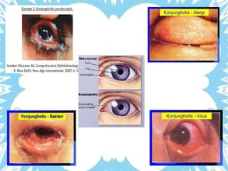 Konjungtivitis | PPTX