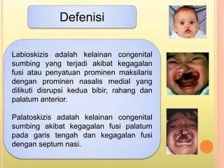 labioskiziz, labiospatokiziz dan atresia esopagus | PPTX