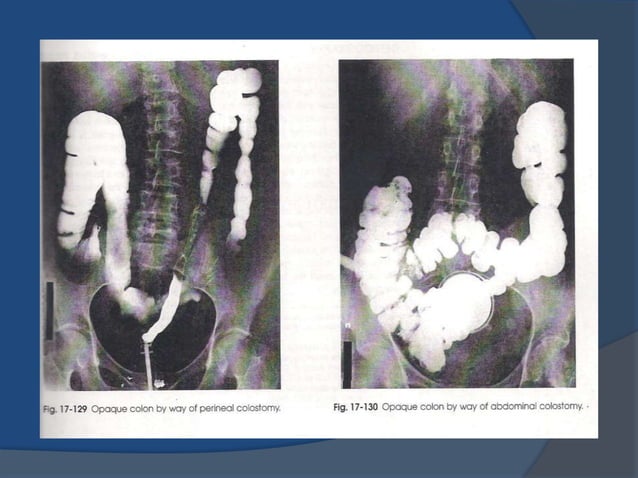 Teknik Radiografi 3 Pemeriksaan Lopografi | PPTX