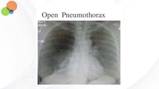 Kelompok 4 Open Pneumothorax.pptx · versi 1.pptx