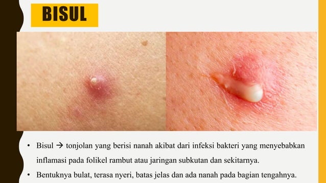 Kelompok 4_Swamedikasi Bisul.pptx