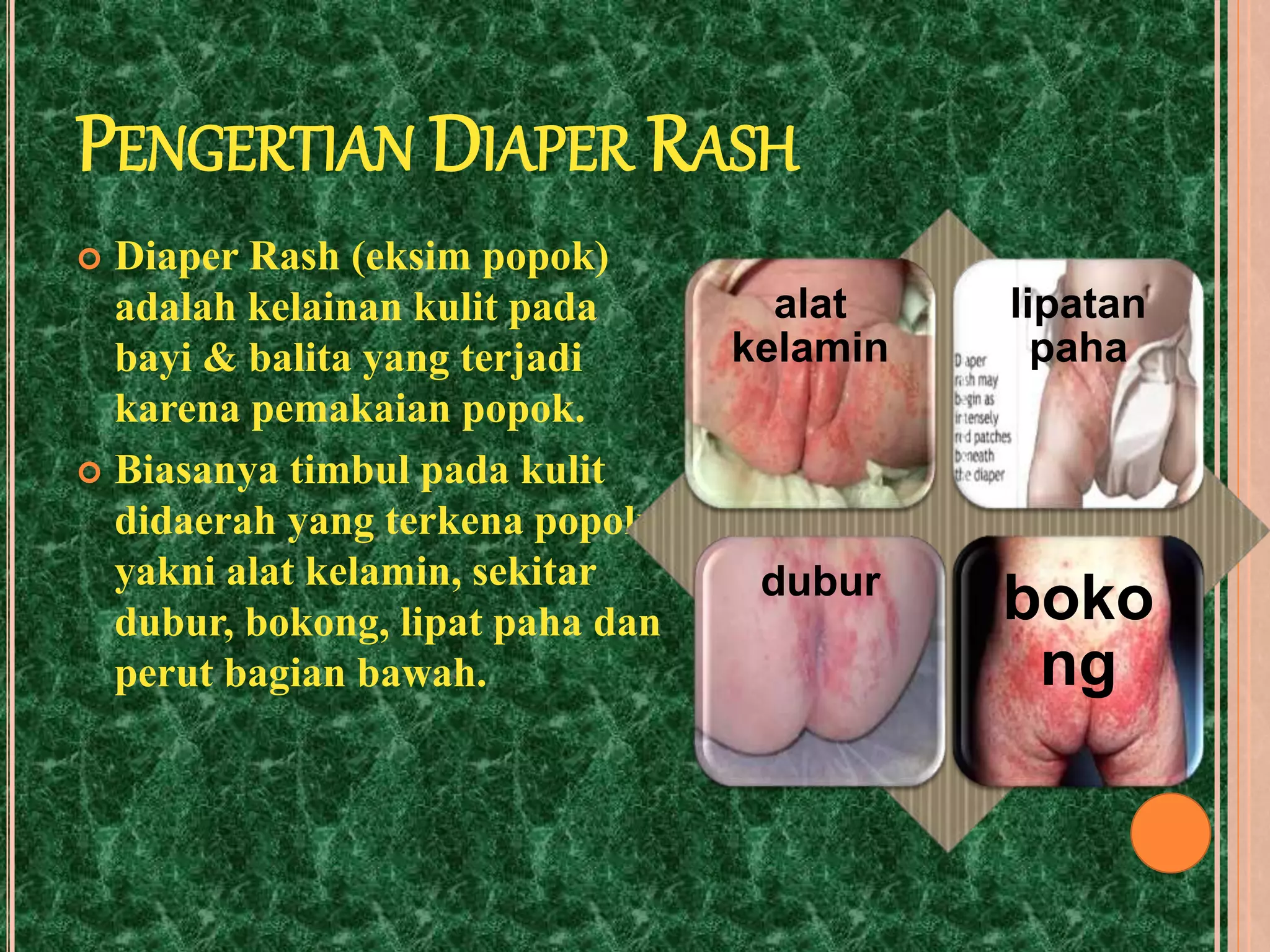 diaper rash | PPTX