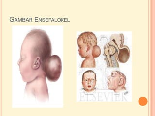 Meningokel dan Ensefalokel Poltekkes Surakarta | PPT