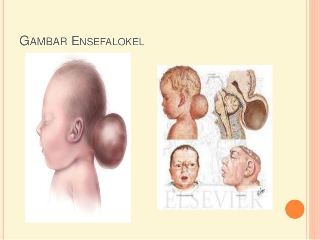 Meningokel dan Ensefalokel Poltekkes Surakarta