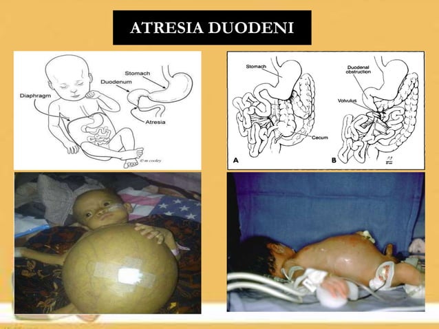 ATRESIA DUODENI DAN OESOPHAGUS | PPT