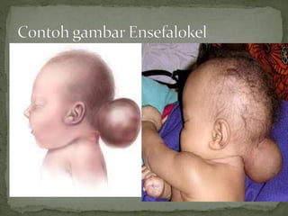MENINGOKEL DAN ENSEPHALOKELKelompok 9 | PPT