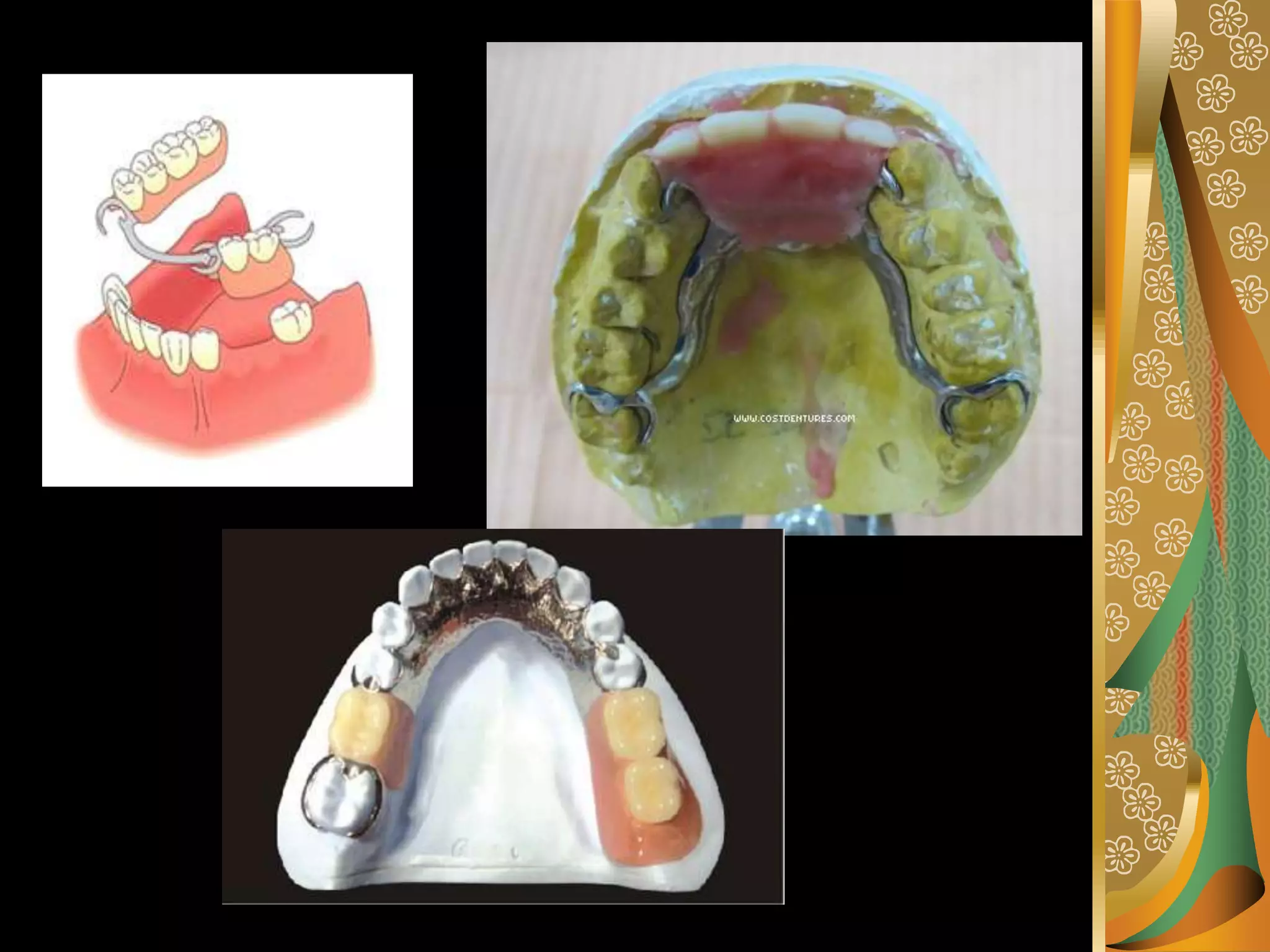 Kennedy classification | PPTX