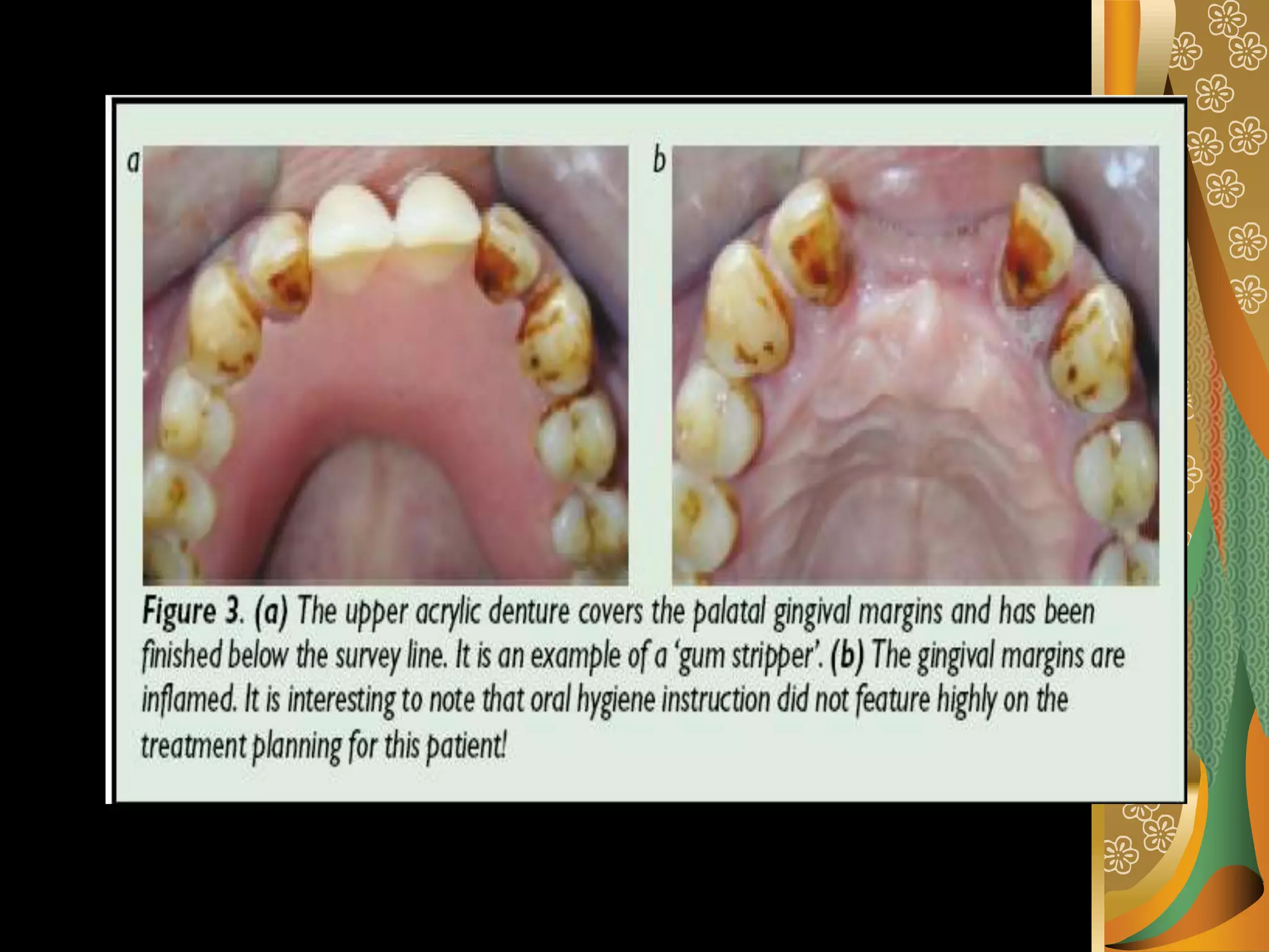 Kennedy classification | PPTX