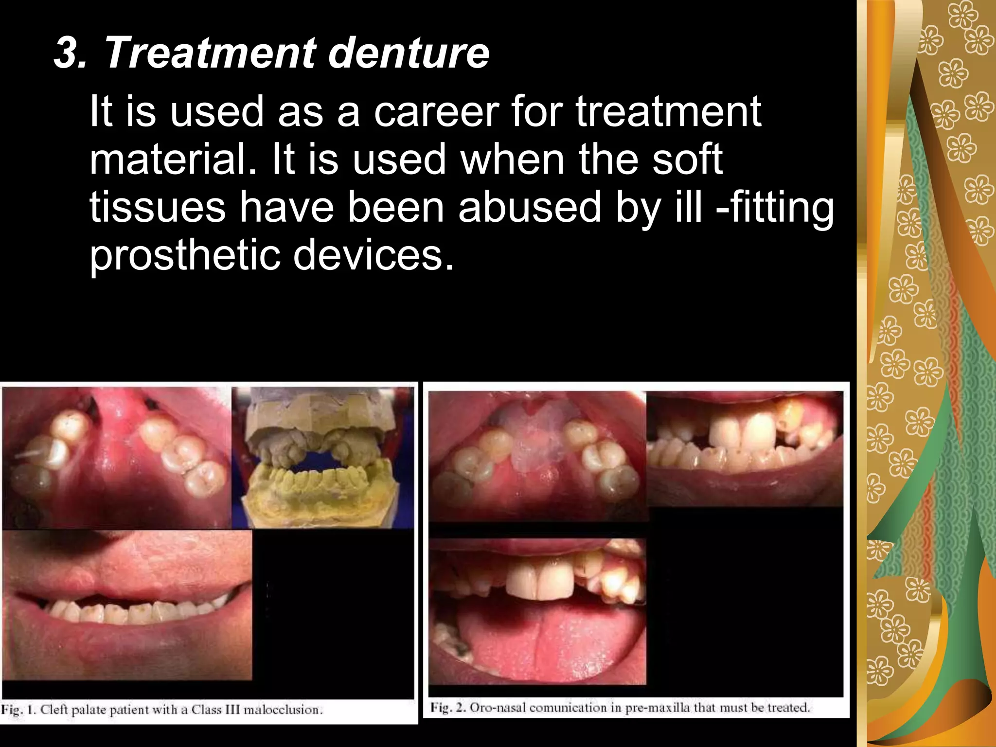 Kennedy classification | PPTX