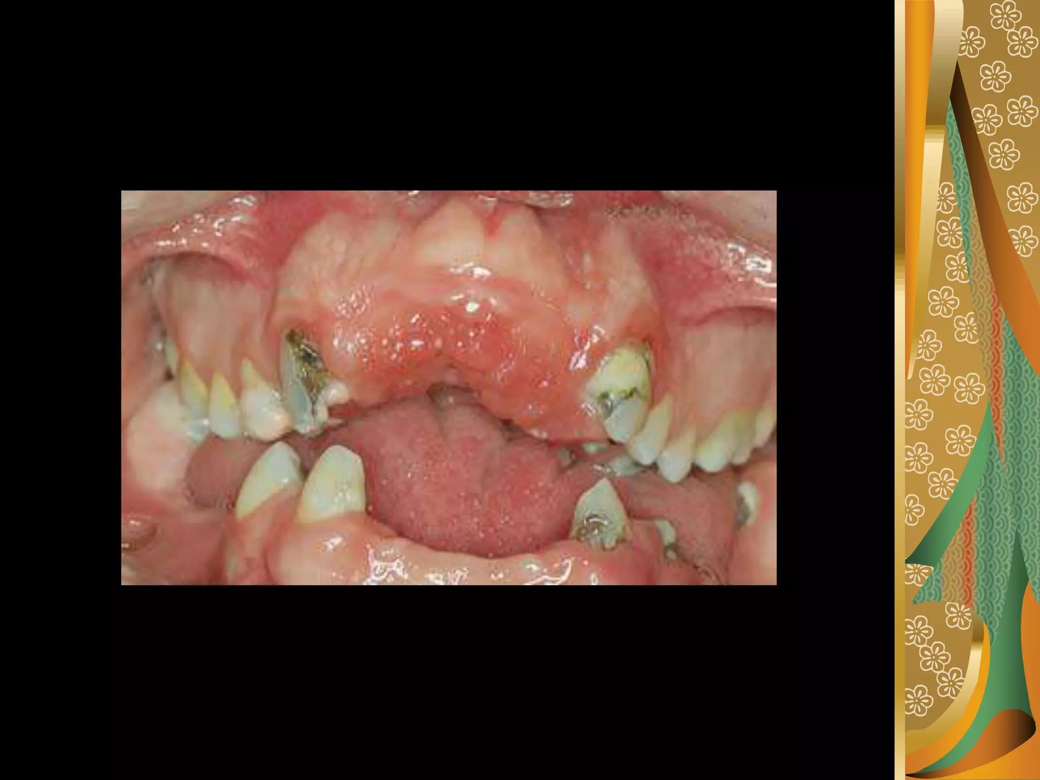 Kennedy classification | PPTX