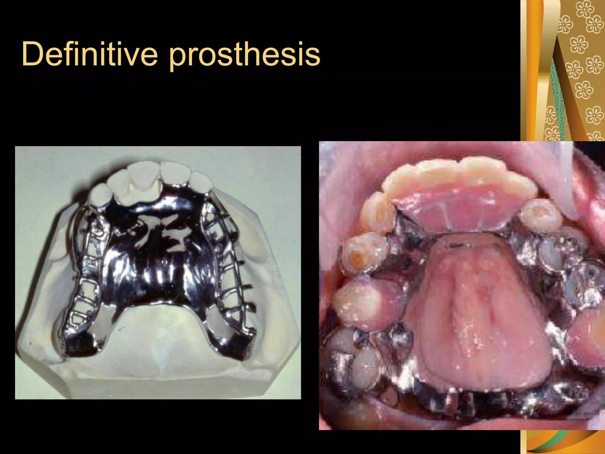 Kennedy classification | PPTX