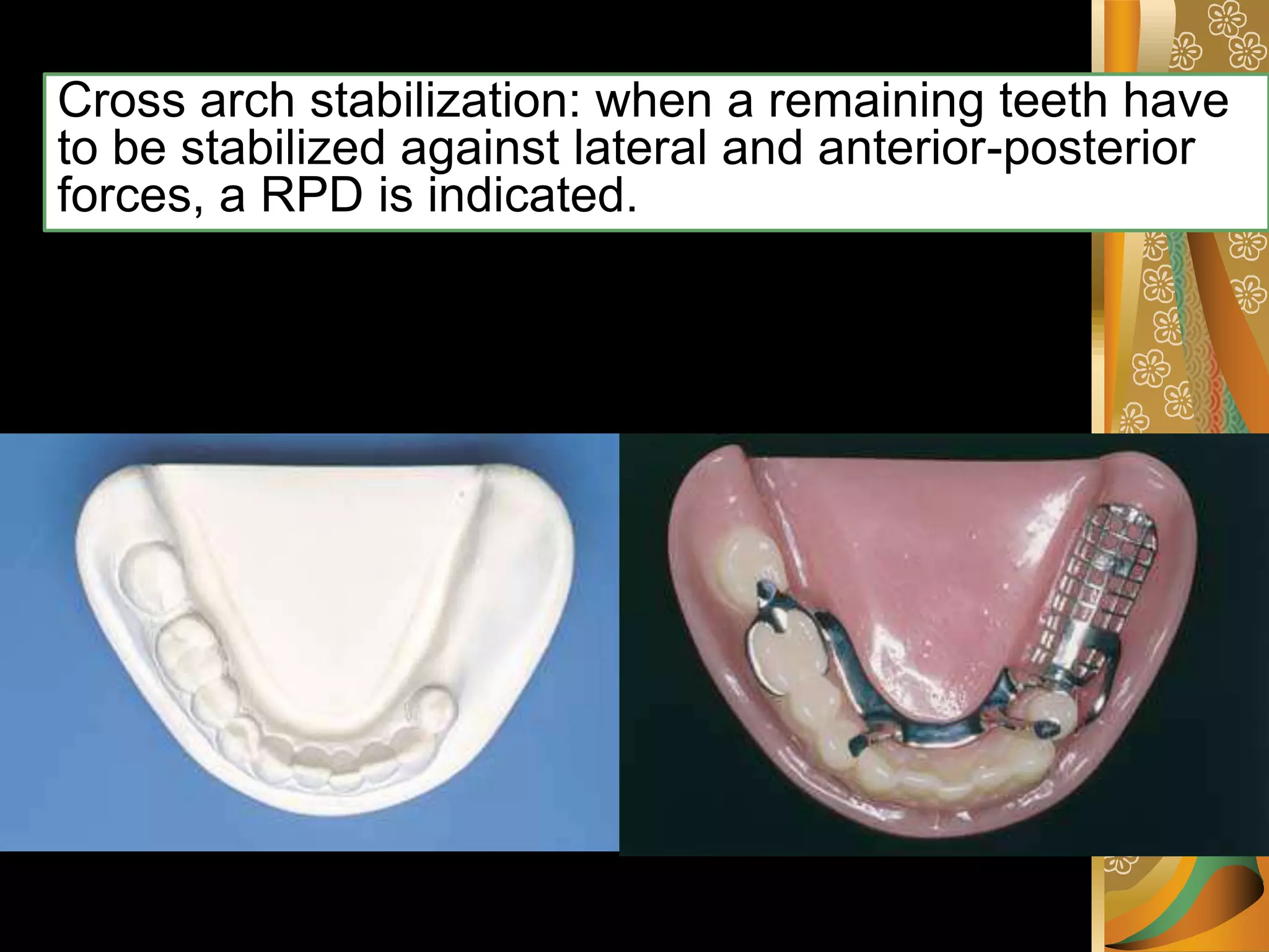 Kennedy classification | PPTX
