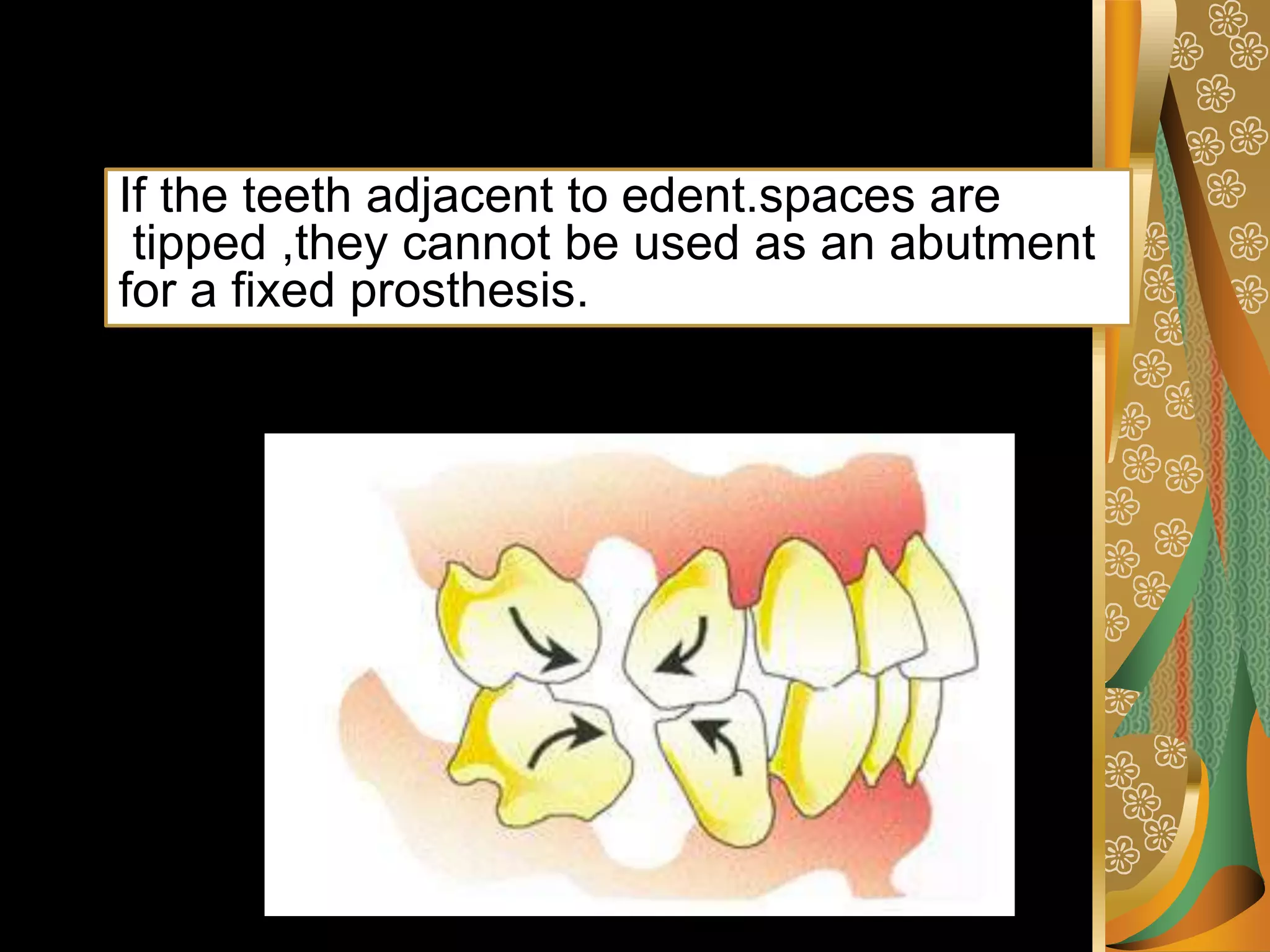 Kennedy classification | PPTX
