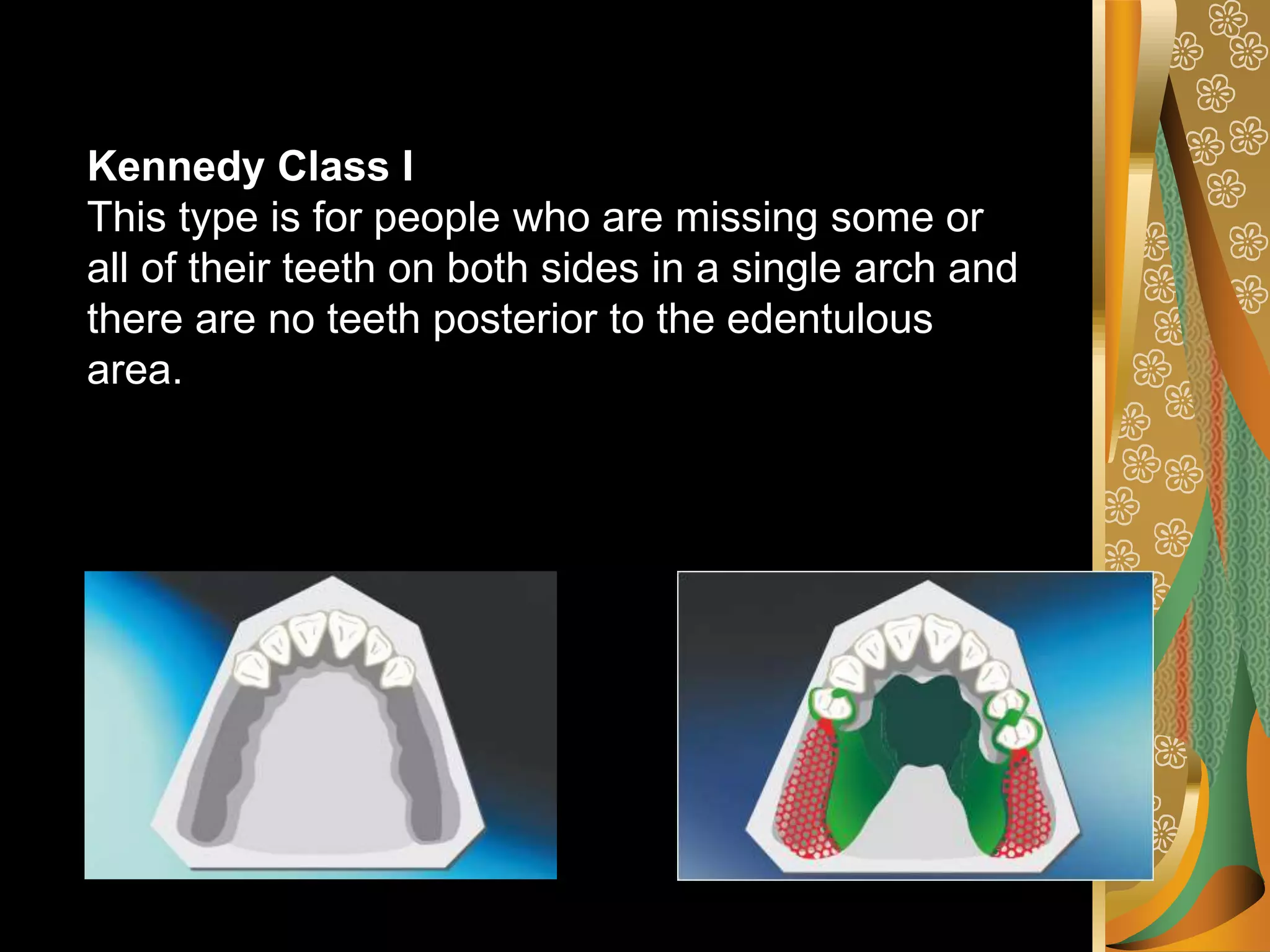 Kennedy classification | PPTX