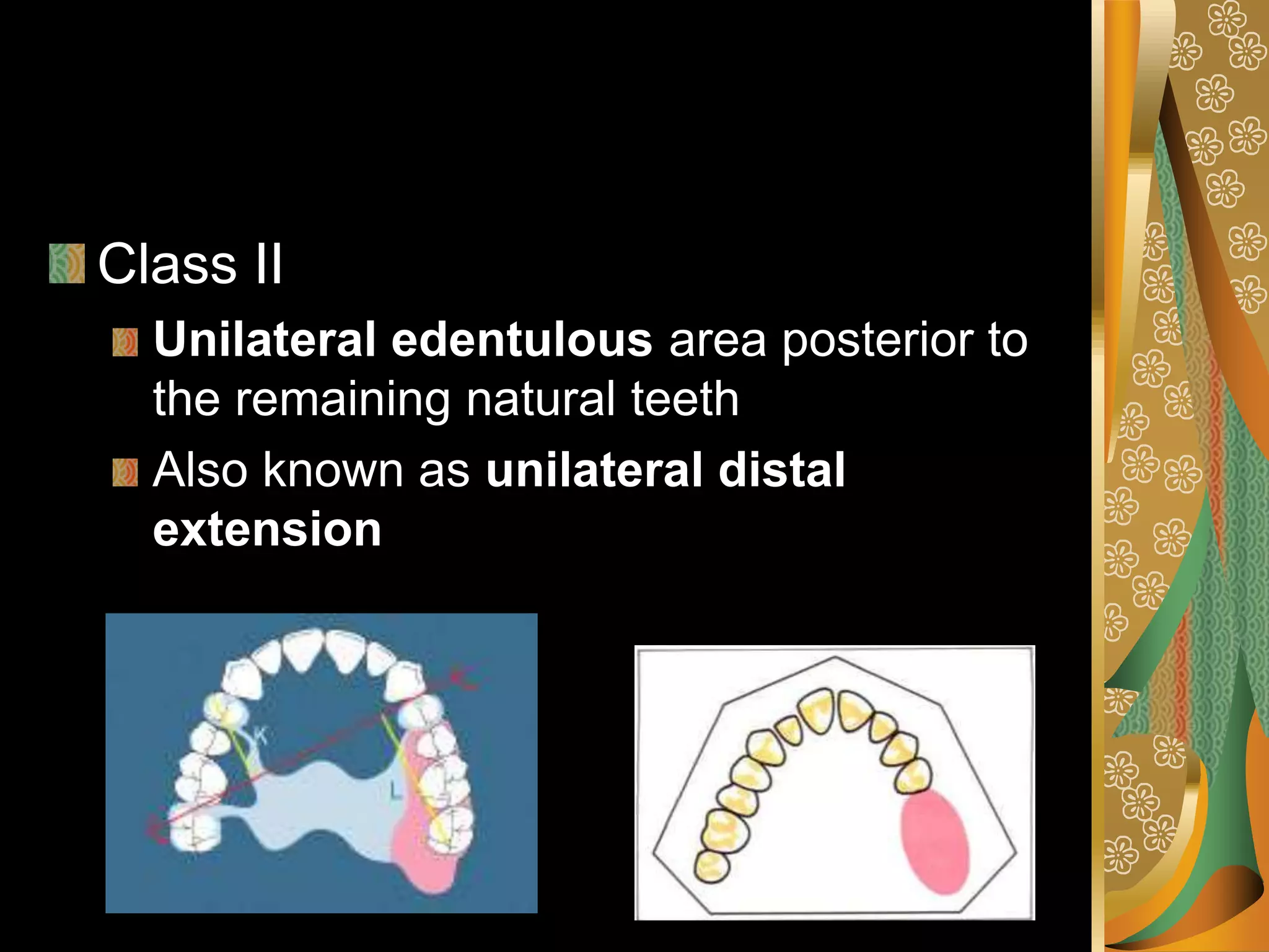 Kennedy classification | PPTX