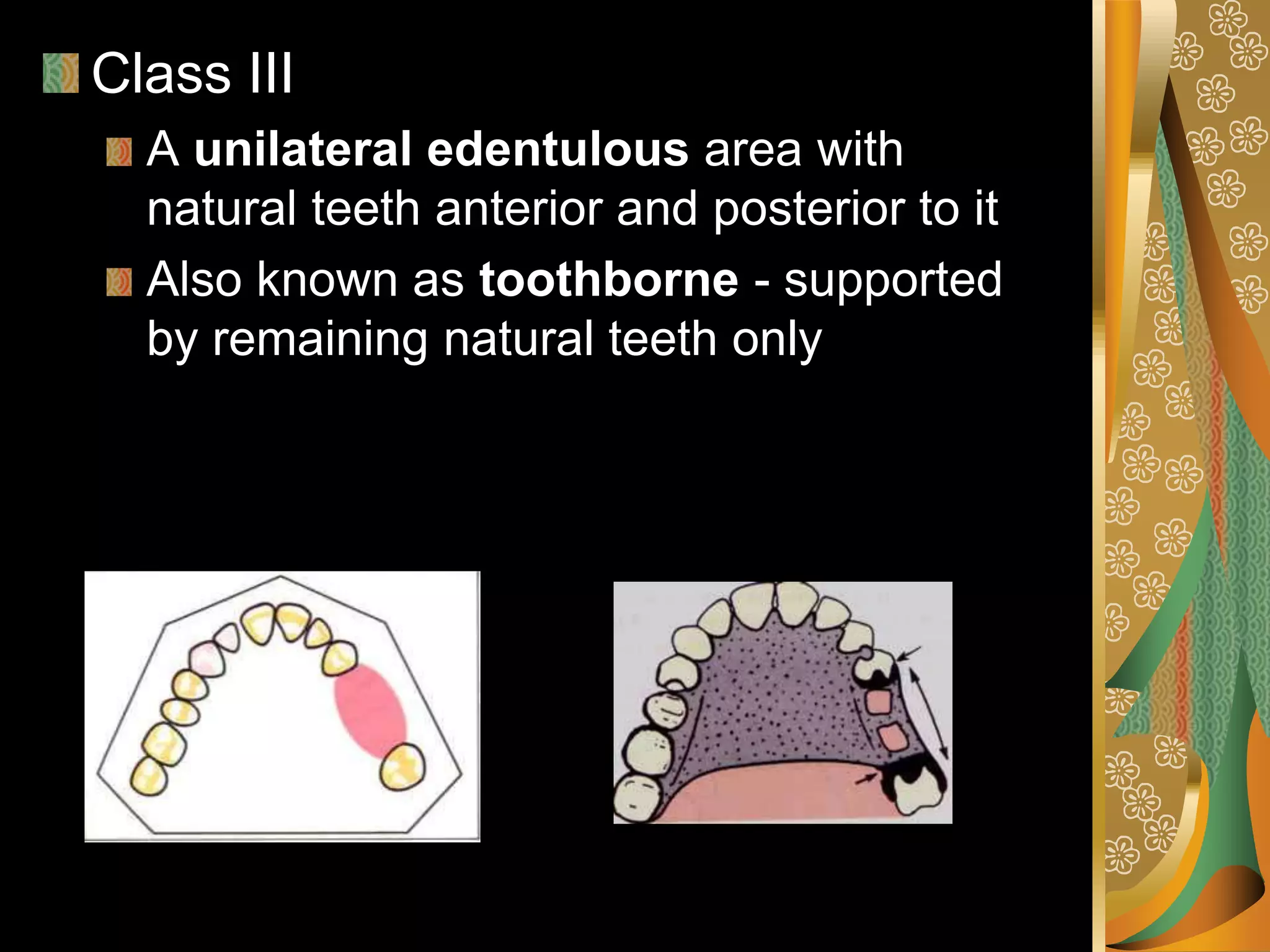 Kennedy classification | PPTX