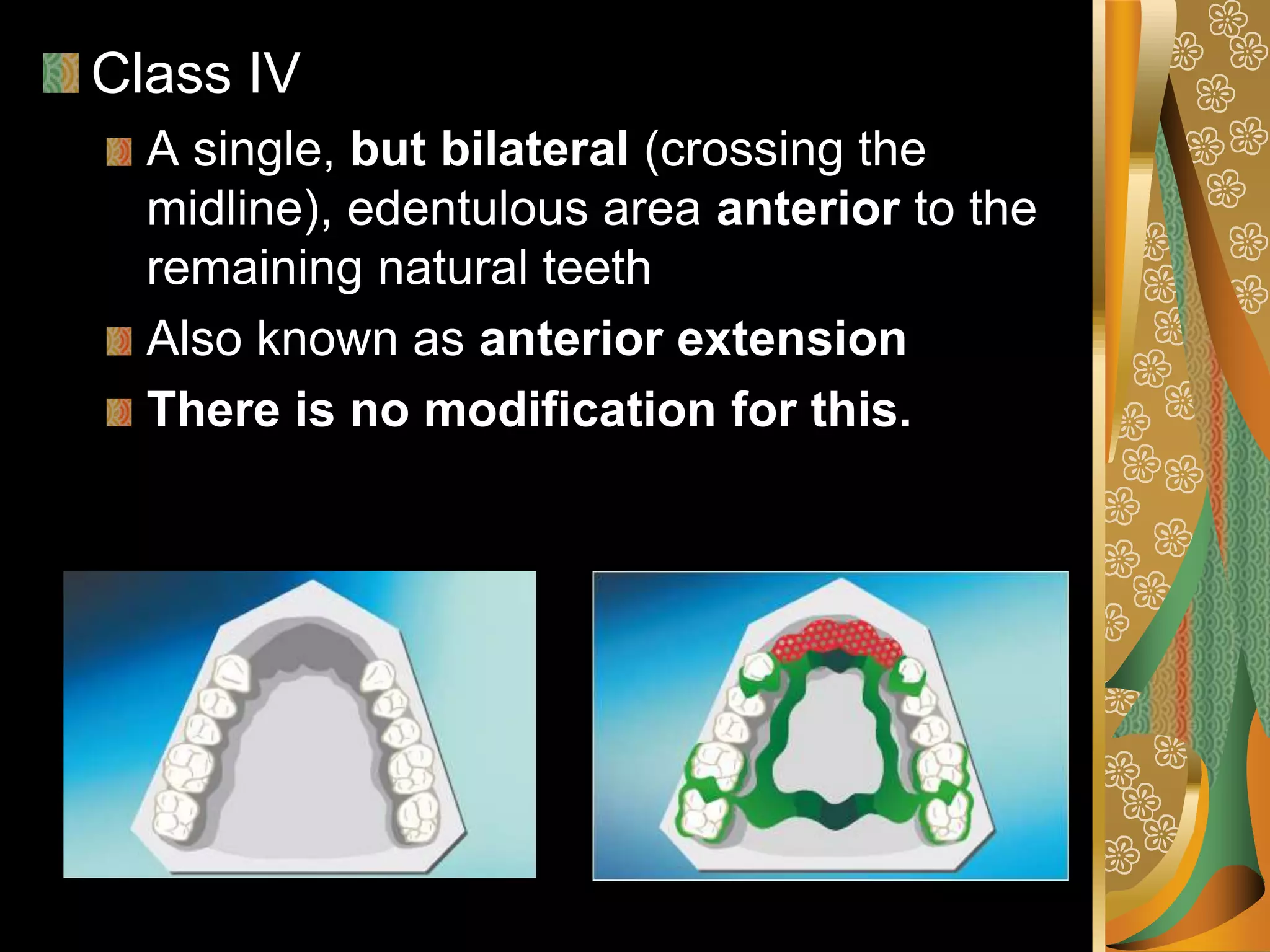 Kennedy classification | PPTX