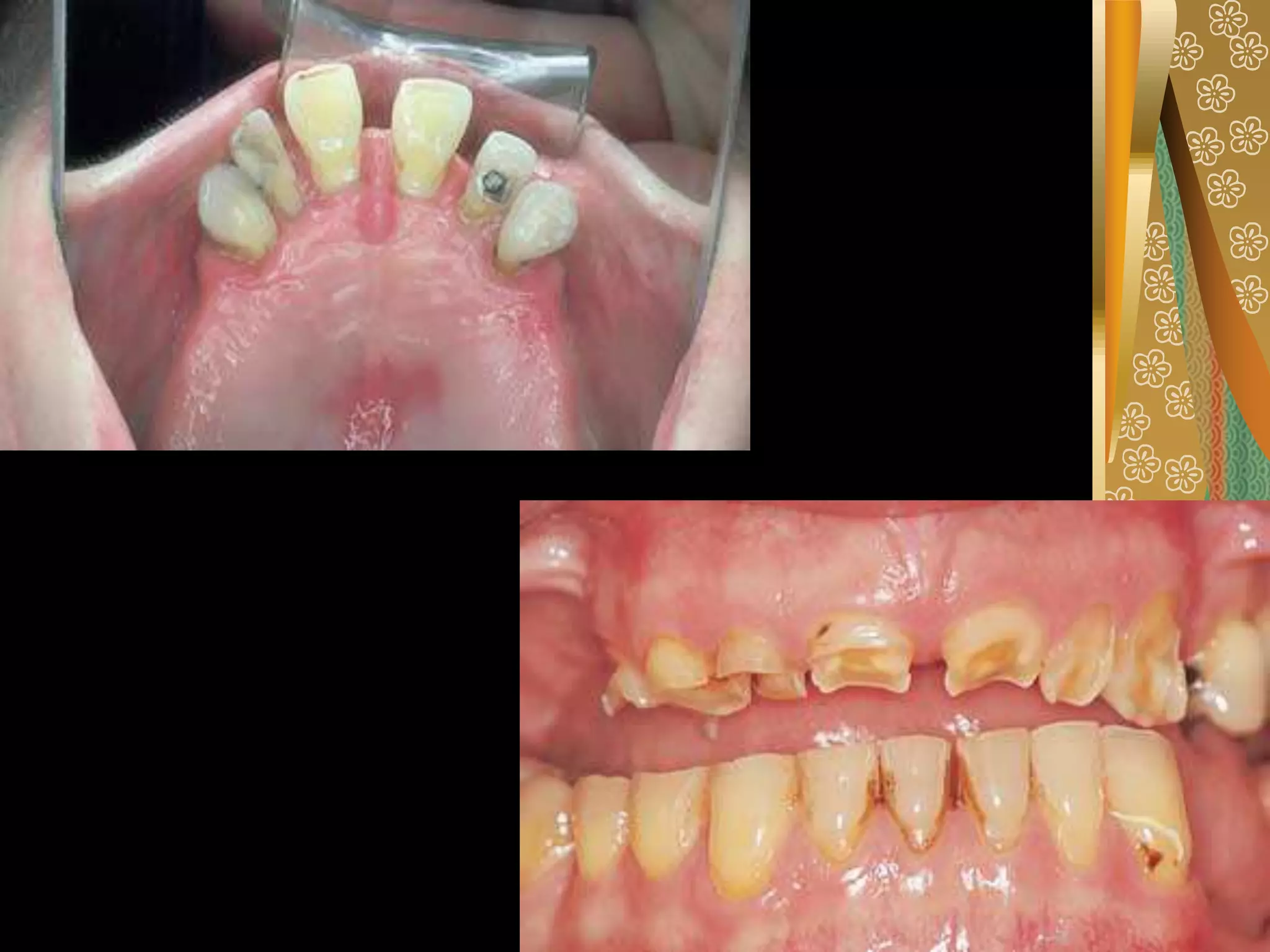 Kennedy classification | PPTX