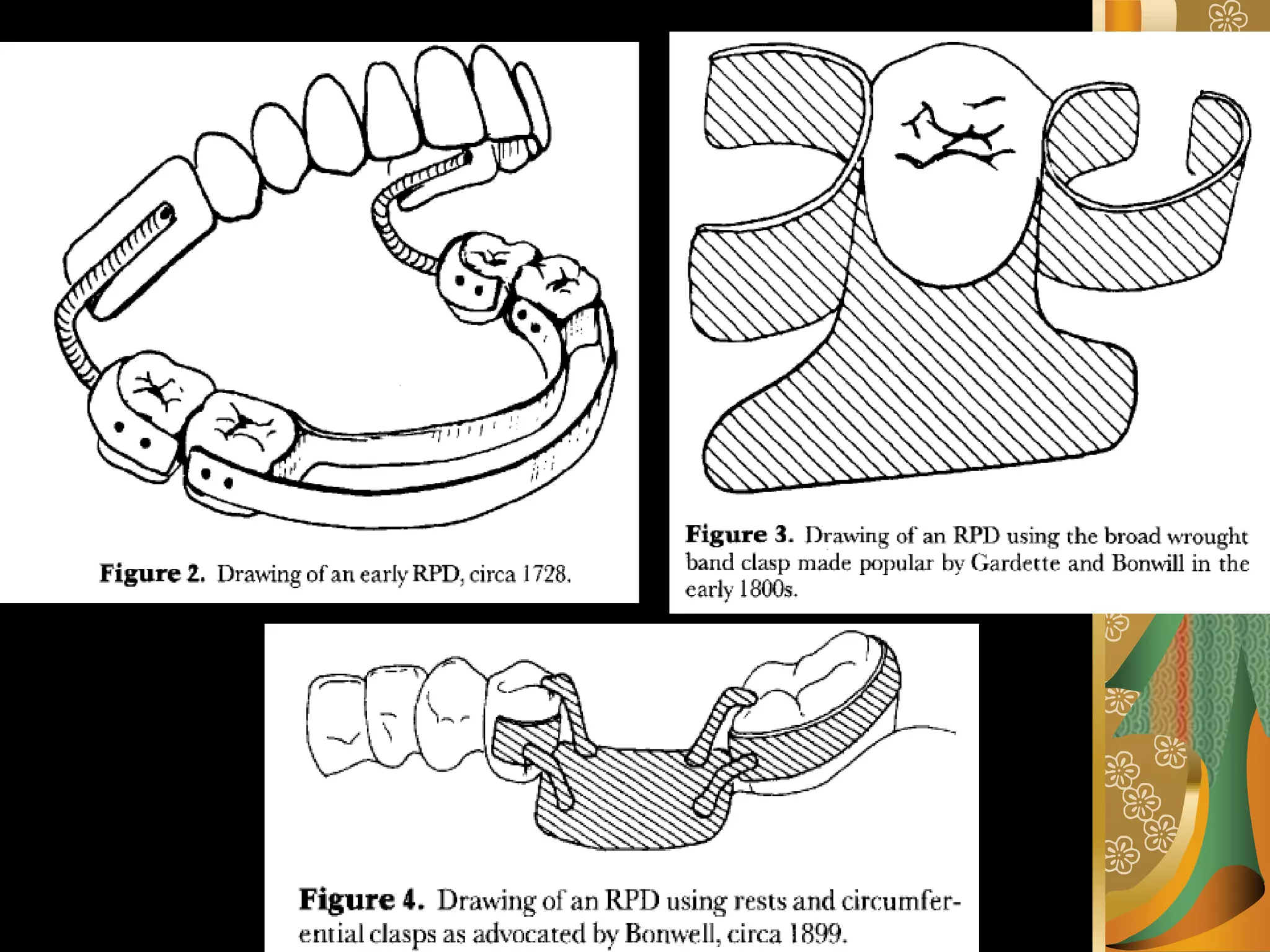 Kennedy classification | PPTX