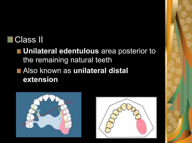 Kennedy classification | PPTX