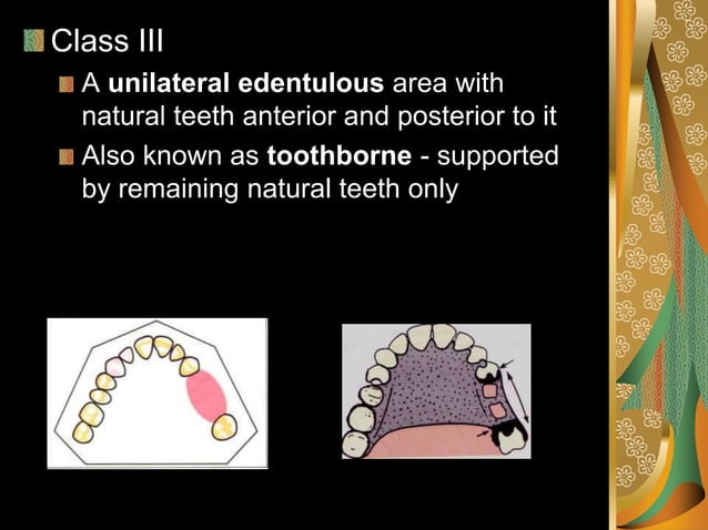 Kennedy classification | PPTX